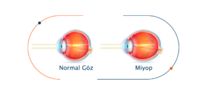 Miyop Göz Tedavisi- Bursa Göz Merkezi